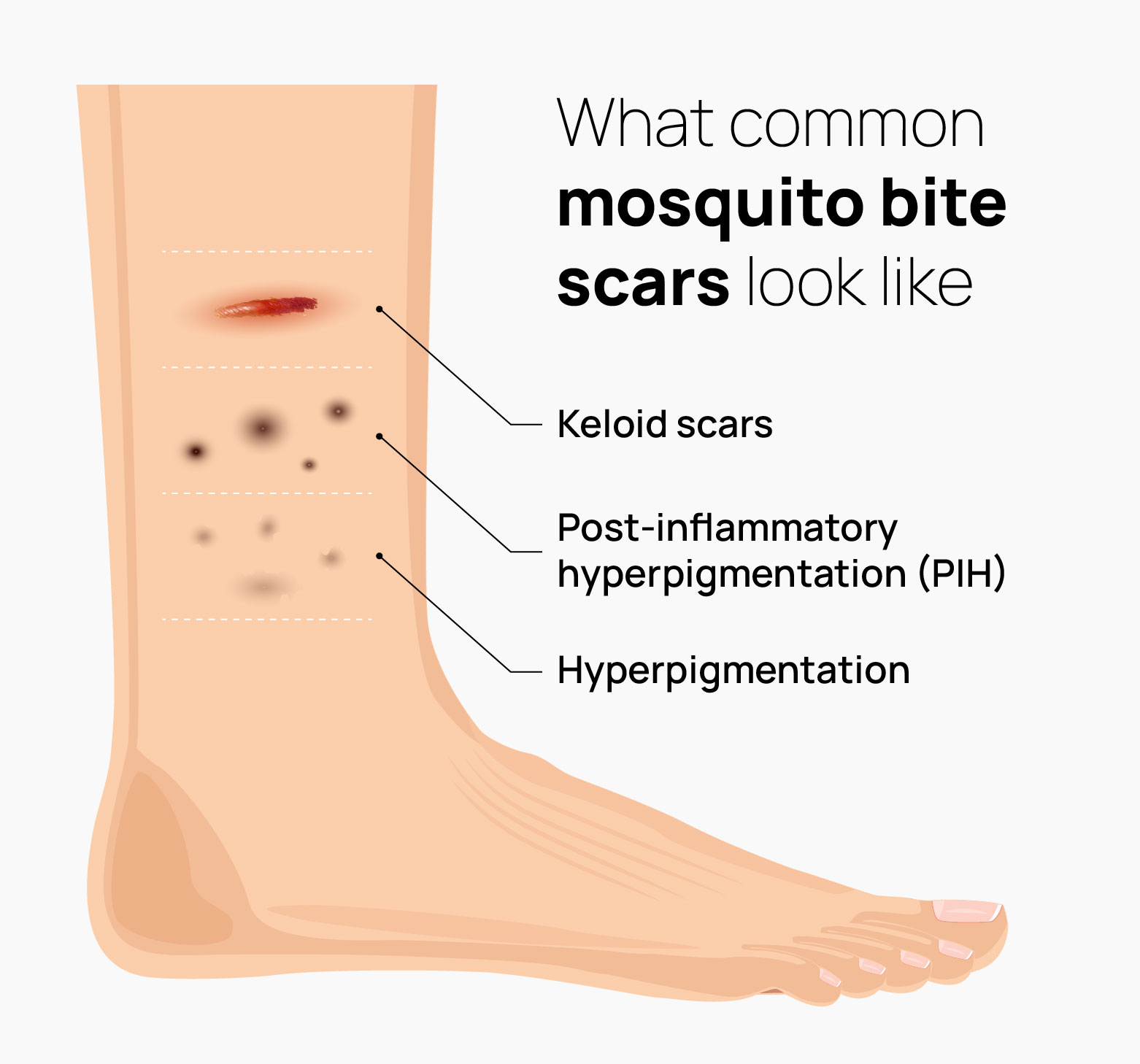 Mosquito Bites Swelling Mosquito Bites Swelling